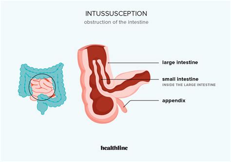 Intussusception Symptoms Causes Diagnosis And Treatment
