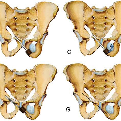 Sagittal Pubic Ramus Fracture With Rotational Displacement Sagittal