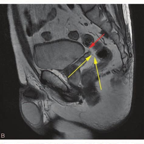 Tumor Location With Respect To Anterior Peritoneal Reflection Yellow