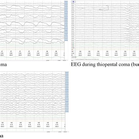 Eeg Pattern Before During And After Thiopental Induced Coma In Our