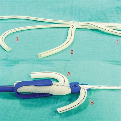 A Custom‐made Thoraflex Hybrid A Cerebral Vessels Branch 16 Mm