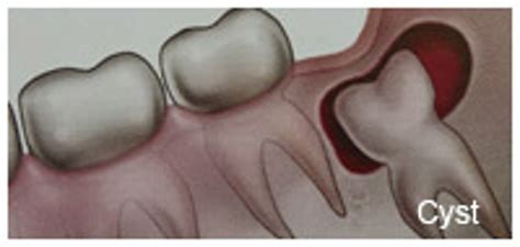 Wisdom Teeth