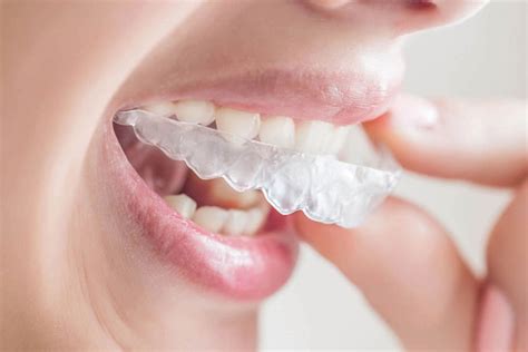3d Predict Aligner Es Cosmetic Dentist Miami Fl 33162