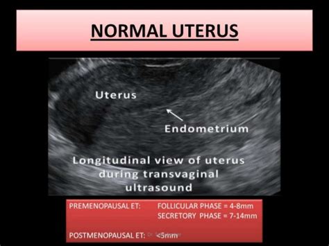 Transvaginal Ultrasound Presentation By Dr Taila Amber