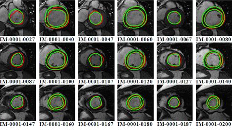 Figure 9 From Automatic Segmentation Of The Left Ventricle From Cardiac Mri Using Deep Learning
