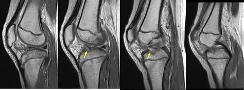 Avulsion Fracture Of Acl Radiology Cases