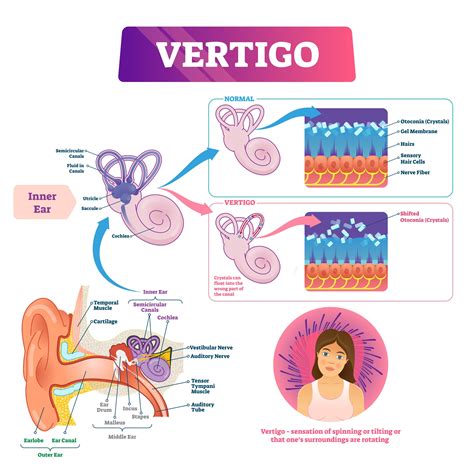 Bppv Benign Paroxysmal Positional Vertigo Treatment