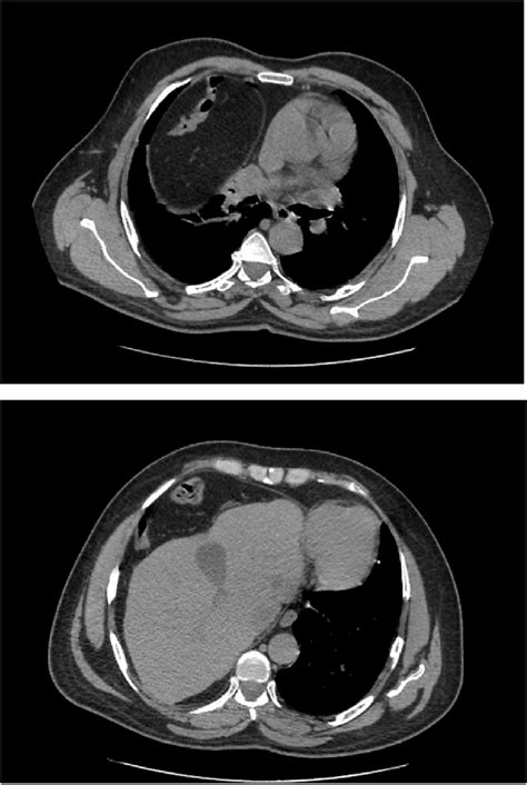 Ct Thorax Confirmed The Eventration By Showing Elevation And Thinning Download Scientific