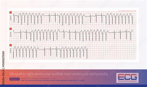 Idiopathic Ventricular Tachycardia Originating From The Right