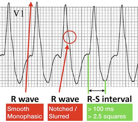 R Wave Ecg