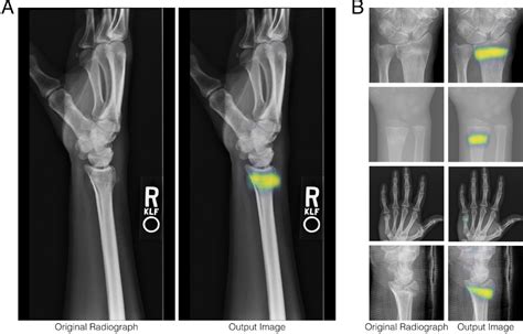 Figure 1 From Deep Neural Network Improves Fracture Detection By