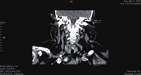 Coronal Ct Scan Of The Neck Showing Heterogeneous Nodular Mass With