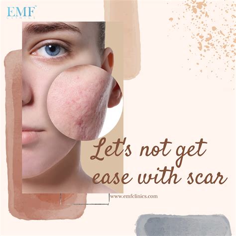 Causes Of Acne Scars And How To Prevent Them Education Journal Of Asia