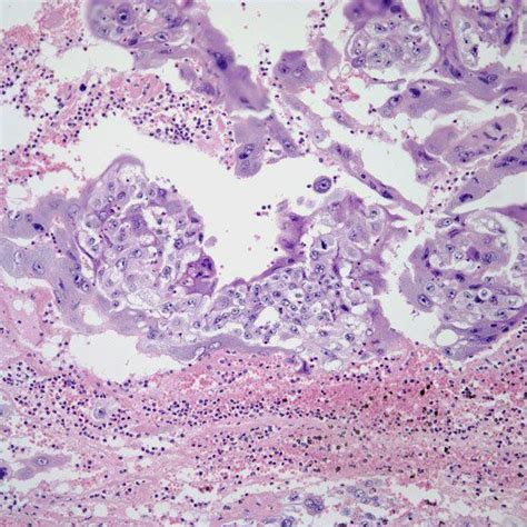 Pembrolizumabchemo May Be New Standard In Dmmrpmmr Endometrial Cancer