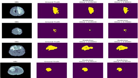 Comparison Results Of Segmentation Result Of Mri Image For U Net And Gi