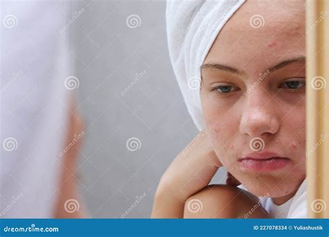 A Sad Teenage Girl Is Looking At The Pimples On Her Face In The Mirror