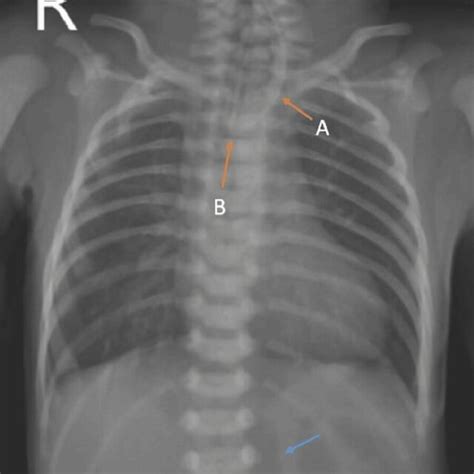 2d Echo Of The Patient Showing Peri Membranous Ventricular Septal
