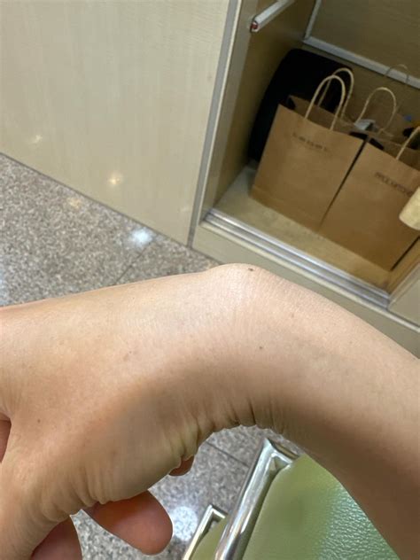這個我的右手也有我有去看過醫生 醫生說不妨礙你的工作就沒關係他就這樣大小 除非今天會讓你很痛不舒服的話就要開刀