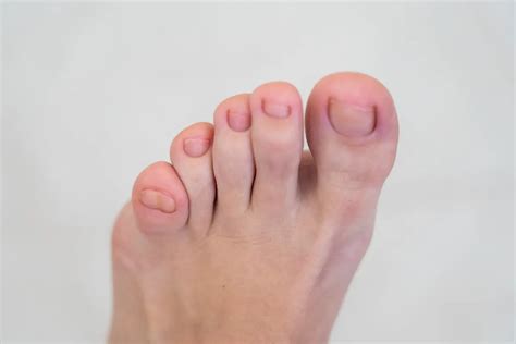 Walking On A Broken Pinky Toe A Comprehensive Guide To Safe Mobility