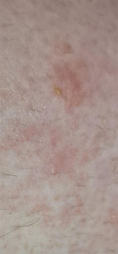 Leg Rash On And Off For Years R Rashyrash