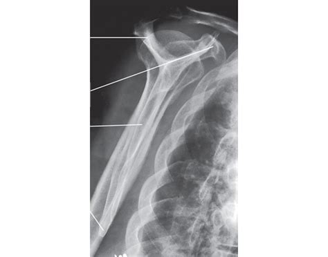 Shoulder Y View X Ray Quiz