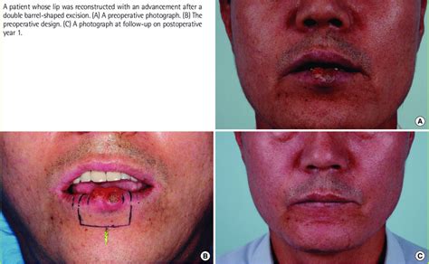 A Case Of Double Barrel Shaped Excision Download Scientific Diagram