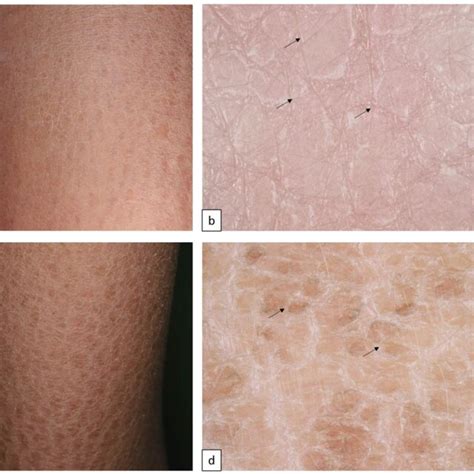 Common Forms Of Inherited Ichthyoses Ichthyosis Vulgaris Is