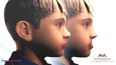 How To Correct Prognathic Mandible And Retrognathic Maxilla Using Chin