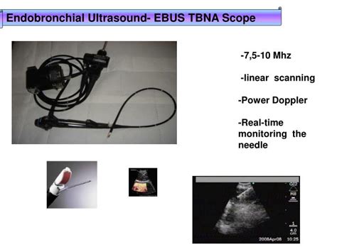 Ppt Endobronchial Ultrasound Powerpoint Presentation Id3040781