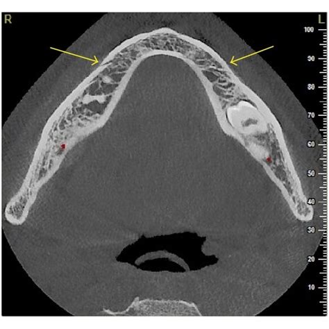 Segmentation Of The Mandibular Canal By Using Cbct Images With Mimics Download Scientific