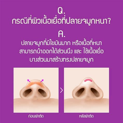 ถ้าปลายจมูกใหญ่ โรงพยาบาลศัลยกรรม เดอะ พลาสติก เซอร์เจอรี