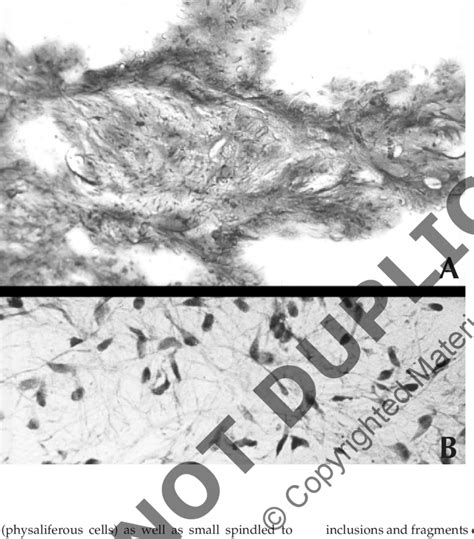 Extraskeletal Myxoid Chondrosarcoma A Tissue Fragments Rich In Download Scientific Diagram
