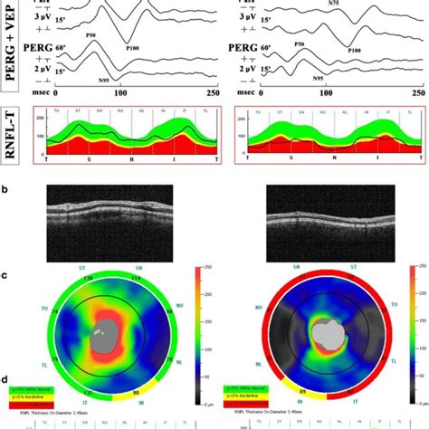 Examples Of Simultaneous Pattern Electroretinogram Perg And Visual