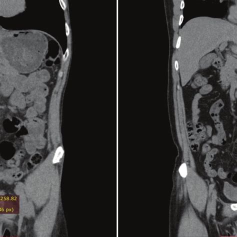 Computed Tomography Of The Inguinal Area 6 Months After Surgery The