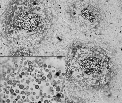 Multifocal Cryptococcus Neoformans Var Neoforms Infection Treatment