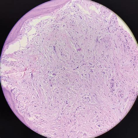 Massons Trichrome Stain Biopsy Shows Very Few Fat Spaces With