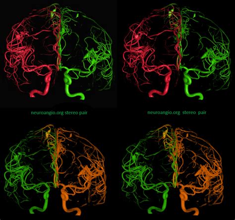 Angiography Cardiac Myxoma Intracranial Aneurysms