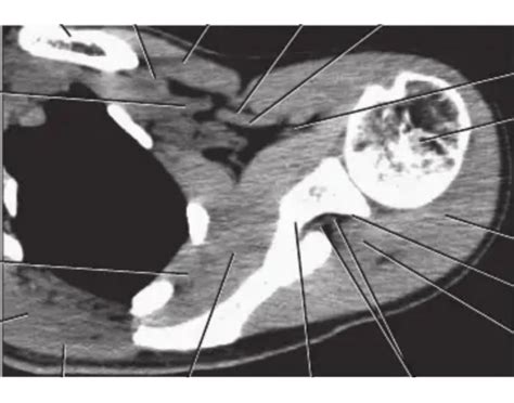 Axial Ct Of L Shoulder With Subscapularis Muscle Quiz