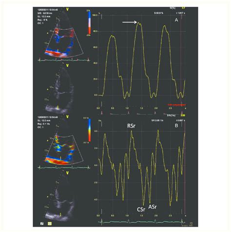 Tissue Doppler Strain A And Strain Rate B Analysis Of The Left Download Scientific Diagram