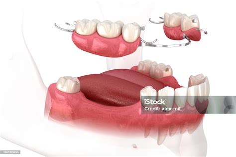 탈착식 부분 틀니 하악 보철 보선학 개념의 의학적으로 정확한 3d 그림 건강관리와 의술에 대한 스톡 사진 및 기타 이미지