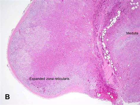 American Urological Association Adrenocortical Hyperplasia