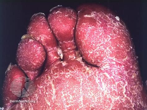 Erythroderma Wikiprojectmed