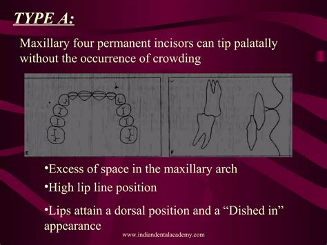 Class 2 Div 2 Malocclusion Ppt