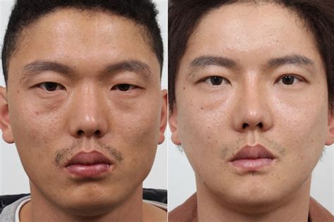전후사진 2 페이지 에필성형외과