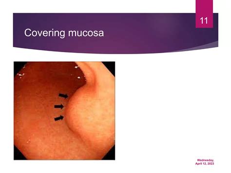 Gastrointestinal Tract Endoscopic Biopsiesppt