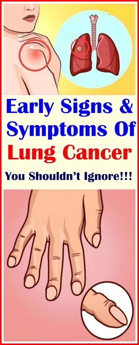 6 Early Signs Of Lung Cancer That You Shouldnt Ignore Wellness Look