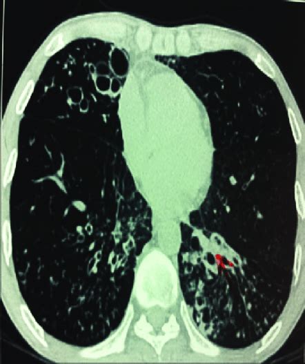 High Resolution Computed Tomography Showing Cystic Bronchiectasis In Download Scientific