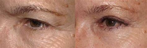 Outer Brow Lift And Upper Blepharoplasty Dr Guy Massry