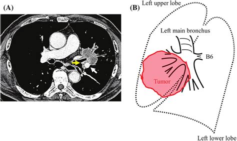 A Contrast Enhanced Ct Of The Chest Showing A Hilar Lung Tumor Of 45