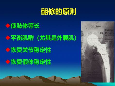人工全髋关节翻修的思考和处理策略！ 德医医学 助力医学教育发展！